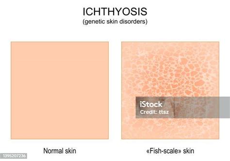 Ichthyosis Kelainan Kulit Genetik Normal Dan Kulit Seseorang Dengan