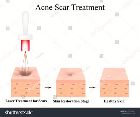 Treatment For Atrophic Scars At Nelson Roberto Blog