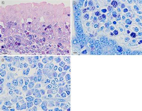 Histology Of Sarcoma Cells A Ureter Intraepithelial And