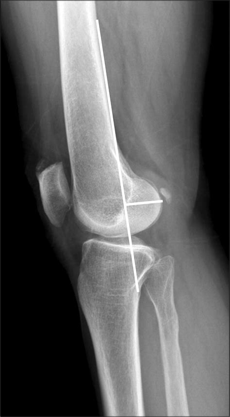 The Posterior Femoral Condylar Offset Is Measured By The Maximum