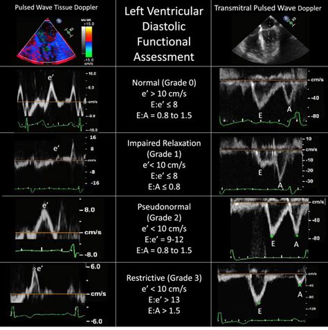 Diastolic Lv Function Iucn Water