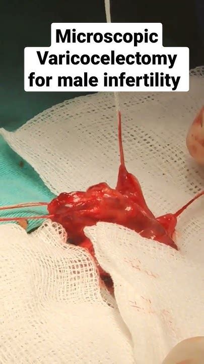 Microscopic Varicocelectomy For Man Infertility By Dr Araz Bayramov Youtube