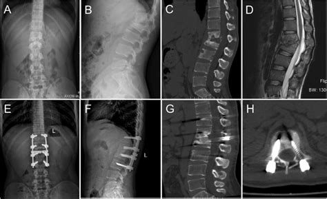 A Year Old Male With L L Lesions AD Pre Operative Images X Ray Download Scientific