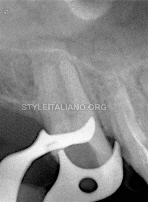 Ledge Detection And Bypass With Explora After Broken File Removal Style Italiano Endodontics