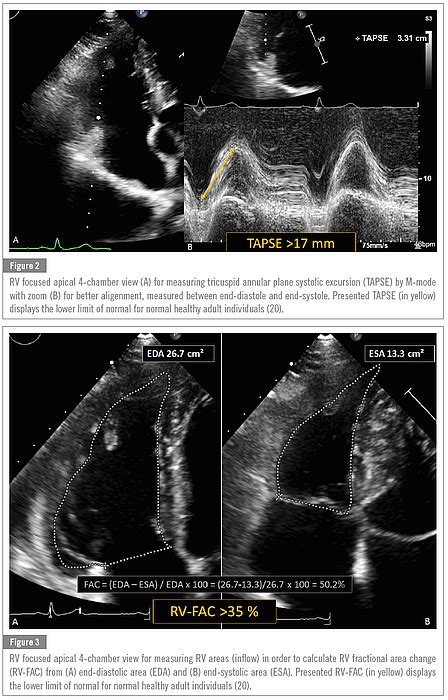 Echocardiographic Criteria For Athlete´s Heart With Cut Off Parameters