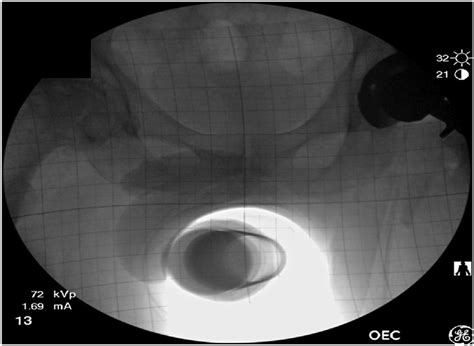 Intraoperative View Of Adjustable Fluoroscopic Grid For Limb Length