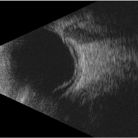 B Scan Ultrasound Demonstrating Inferior Retinal Detachment Download Scientific Diagram