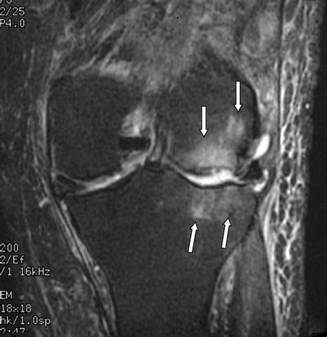 Bone Marrow Edema Syndrome