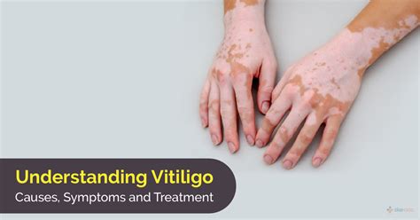 Vitiligo Causes Symptoms Treatment And Diagnosis Skedoc