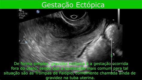 Ultrassonografia Transvaginal Gestação Ectópica YouTube