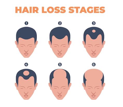 Hair Transplant Cost London Uk Is Around £5000 £15000