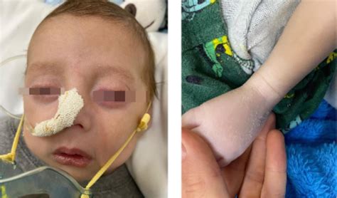Sjogren Larsson Syndrome In Twins Case Report