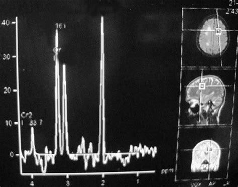 Magnetic Resonance Spectroscopy Single Voxel At 135 Ms Showing A