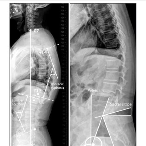 Sagittal Balance And Spinopelvic Parameters Download Scientific Diagram