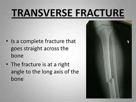Fracture Chapter 4 Presentation Ppt