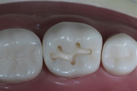 Proximal Box International Dentist Central