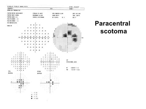 Glaucoma