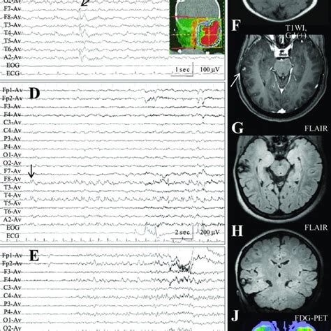 A B Interictal Electroencephalography Eeg Demonstrates Paroxysmal Download Scientific