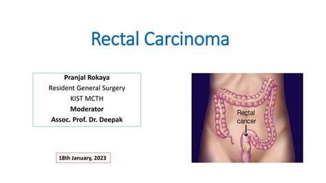 Rectal Carcinoma Pptx