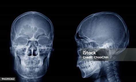 非常好的品質的 X 射線圖像正常的人顱骨前 視圖 過程中的藍色色調孤立的黑色背景 照片檔及更多 X光片 照片 Istock