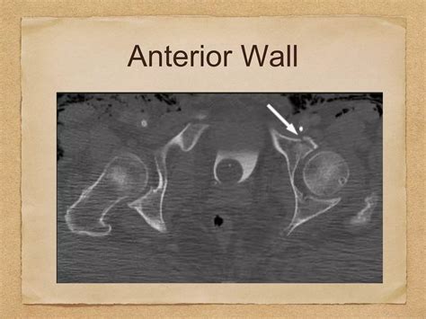 Acetabular Fracture Radiology Xrays Ct Scan And 3d Printing Pptx