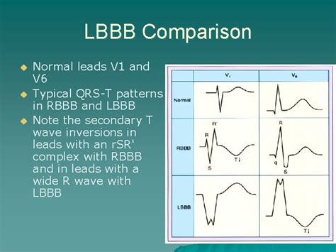 Practical Electrocardiography Bundle Branch Block Scott Ewing D
