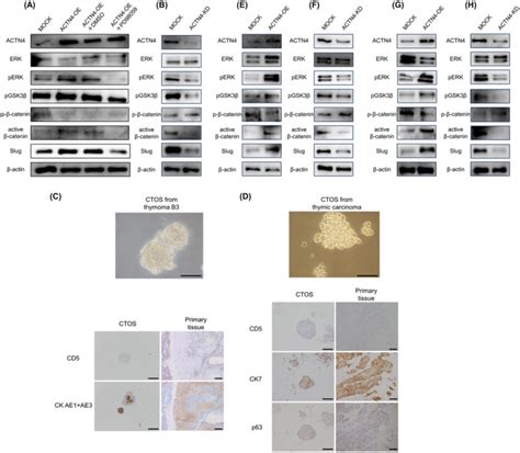 Actn4 Is Associated With The Malignant Potential Of Thymic Epithelial