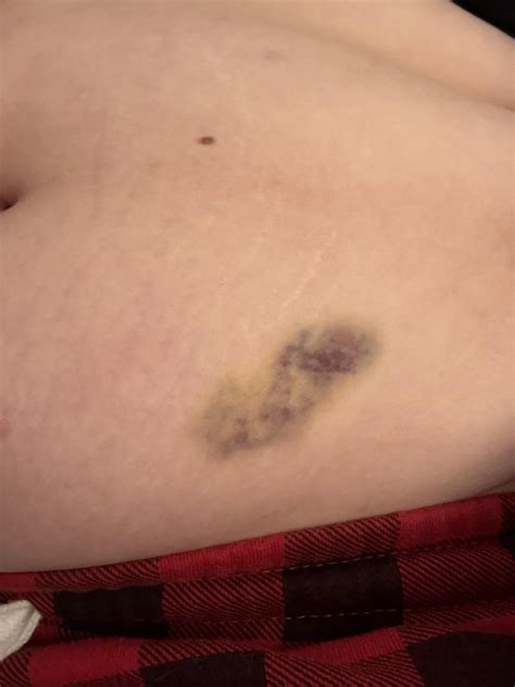 Is This Normal Bruising For An Injection R Liraglutide
