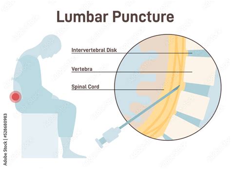 Subarachnoid Space Lumbar Puncture