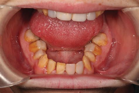 How To Use A Single Shade Composite System In An Indirect Application