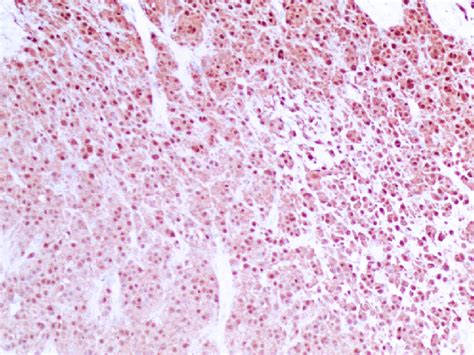 Immunohistochemistry Showed Calretinin Staining As Strongly Positive