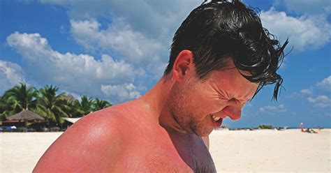 5 Tips For Treating Sunburn Oceanic Worldwide