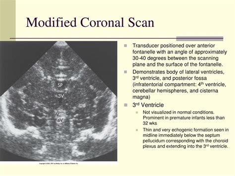 Ppt Neonatal Echoencephalography Powerpoint Presentation Free Download Id5519290