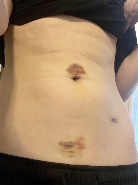 Appendix Removal Scar