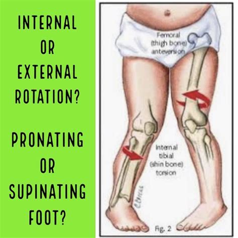 Tibial Internal Rotation