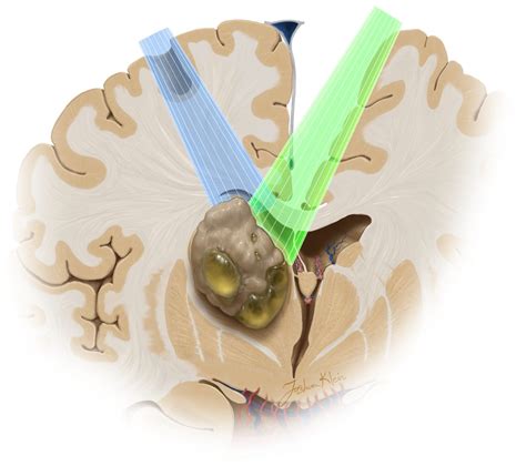 The Neurosurgical The Contralateral Anterior Interhemispheric