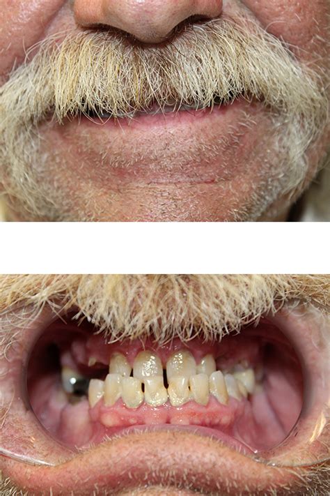 Tmj Treatments Gallery Before And After Patient 32 Tmj Expert