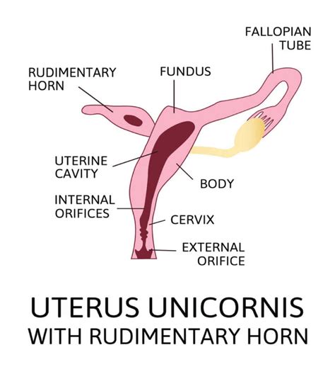 Unicornuate Uterus Treatment Causes And Its Type Birla Fertility And Ivf