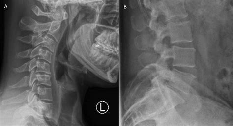 Lumbosacral Joint Lateral View