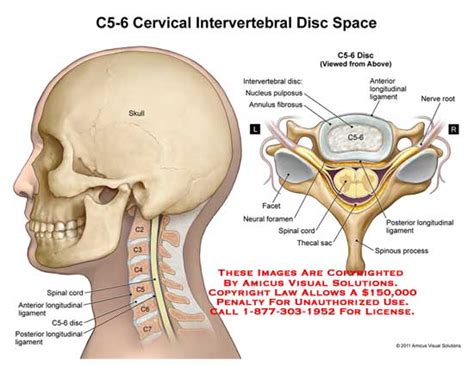 1120601x C5 6 Cervical Intervertebral Disc Space Anatomy Exhibits