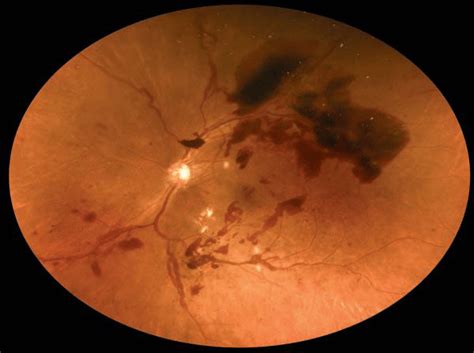 High Risk Proliferative Diabetic Retinopathy Although Diabetes Is A