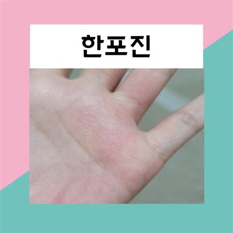 손가락 한포진 원인 증상 전염될까 초기치료가 중요해요 네이버 블로그