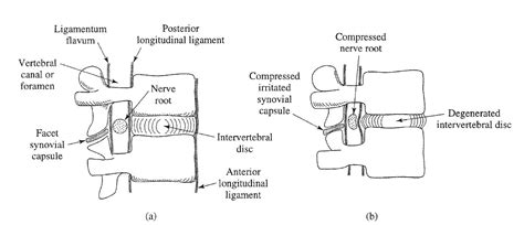 36 Cross Section Of Two Vertebrae And A Vertebral Disc With