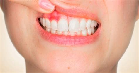 Dicas e Artigos Inflamação na gengiva afeta tentativa de engravidar
