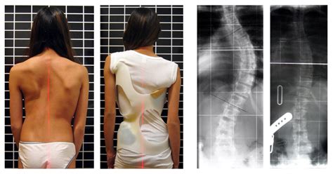 Non Surgical Scoliosis Treatment Everything You Need To Know
