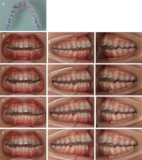 12 Tmj Splint Types Margretstanley 12 Tmj Splint Types Margretstanley