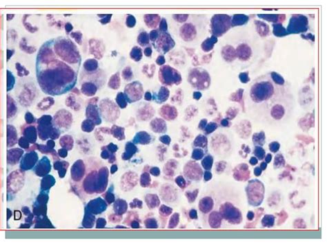 Myelodysplastic Syndromes Ppt
