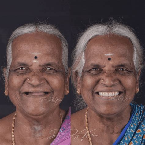 Get Your Bps Dentures From Experienced Dentists In Gurgaon