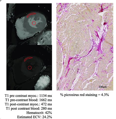 Example Of Pre And Post Contrast T1 Maps And Histophatology Pre And