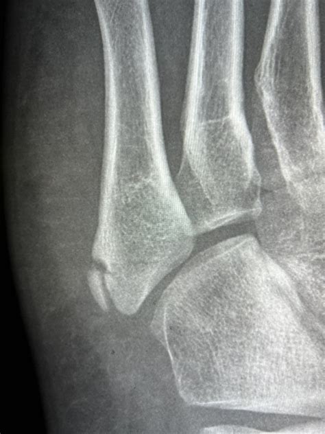 Sameer Raniga On Twitter Fracture And Apophysis Of The Base Of Th